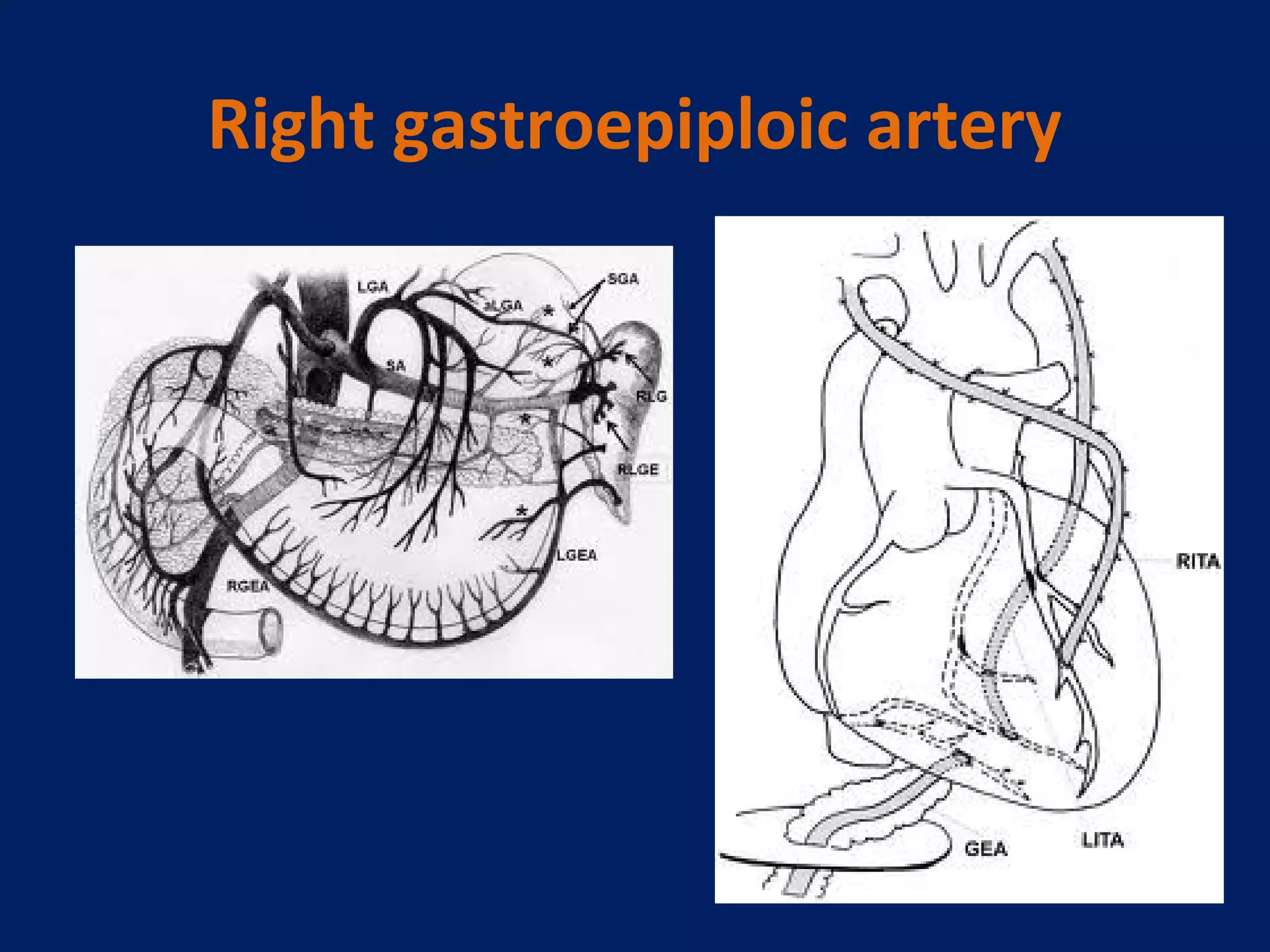 Coronary Artery Bypass Graft (CABG) Surgery | PPT