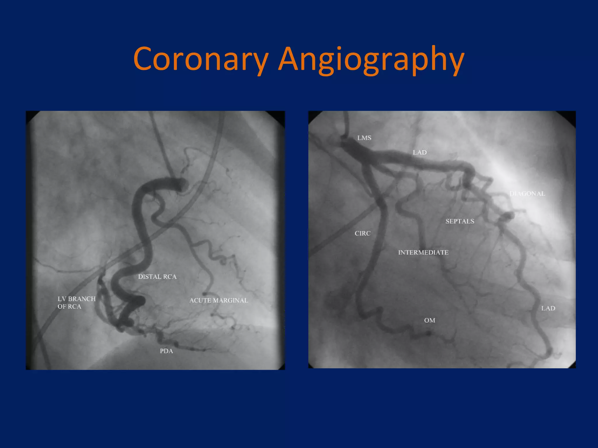 Coronary Artery Bypass Graft (CABG) Surgery | PPT