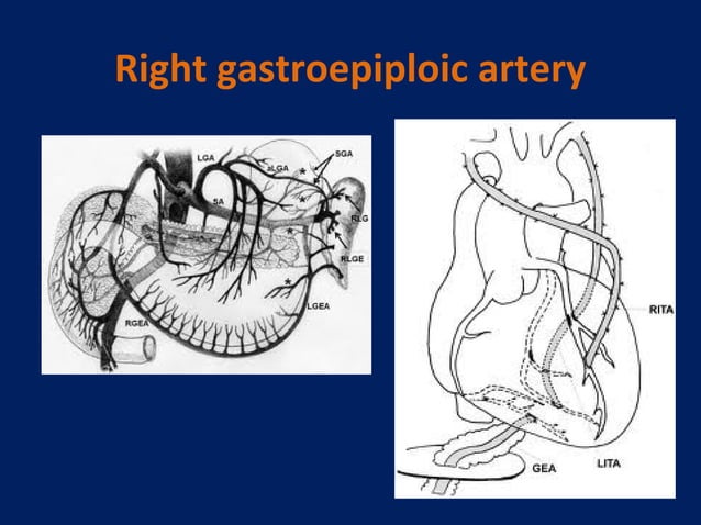 Coronary Artery Bypass Graft (CABG) Surgery | PPT