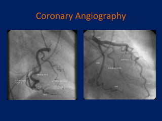 Coronary Artery Bypass Graft (CABG) Surgery | PPT