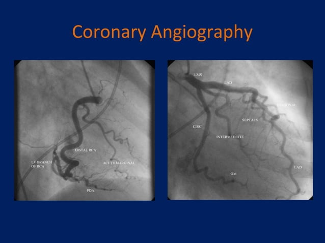 Coronary Artery Bypass Graft (CABG) Surgery | PPT