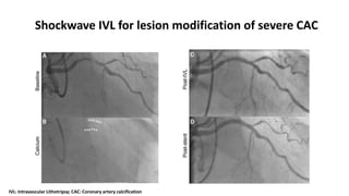 Coronary Calcium Modification | PPTX
