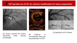 Coronary Calcium Modification | PPTX