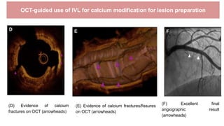 Coronary Calcium Modification | PPTX