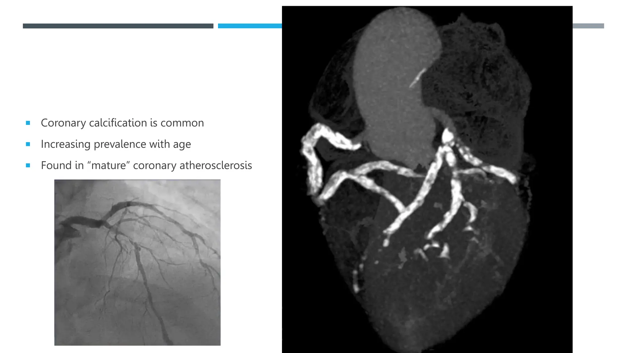 coronary artery calcification.pptx