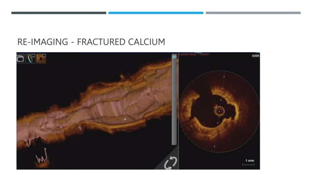coronary artery calcification.pptx