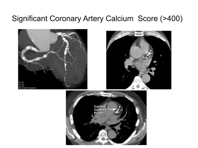 Coronary artery calcium scoring IDoR 2018 | PDF | Heart and ...