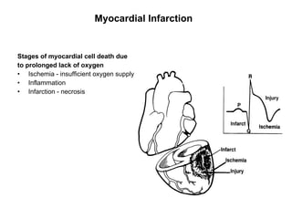 Pathophysiology of Coronary Artery Disease | PPT