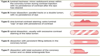Coronary artery dissection | PPTX