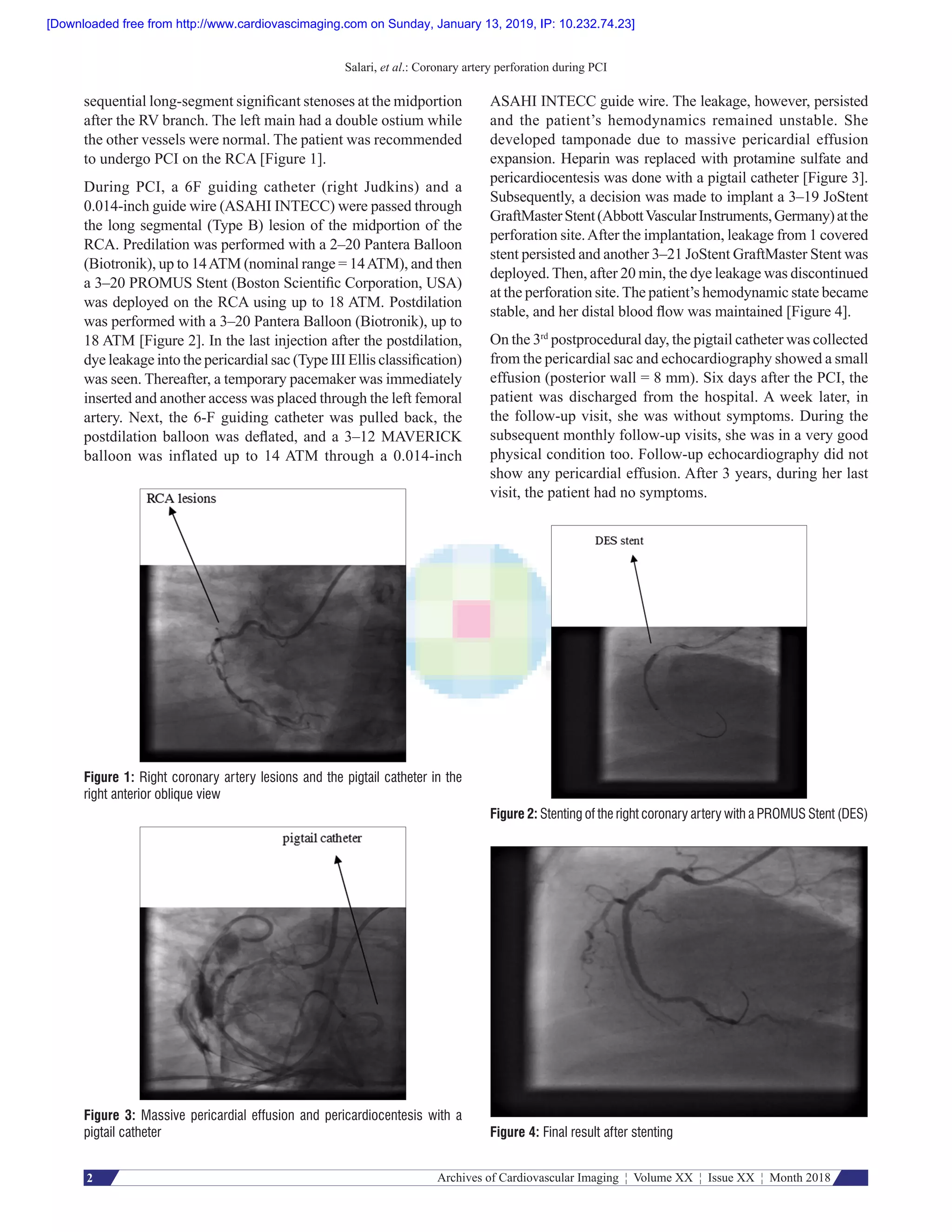Coronary artery perforation during percutaneous coronary | PDF