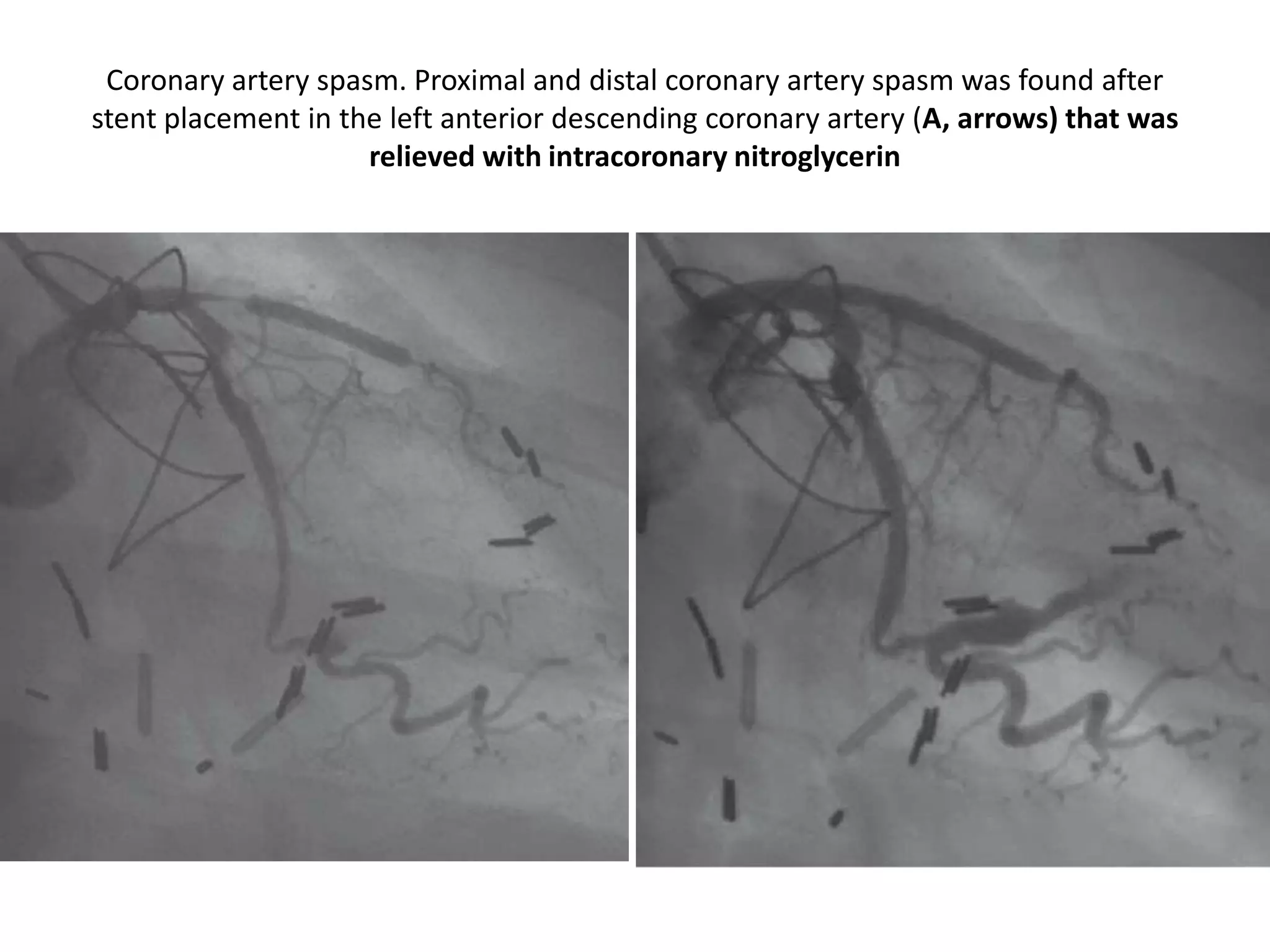 Coronary artery spasm | PPTX