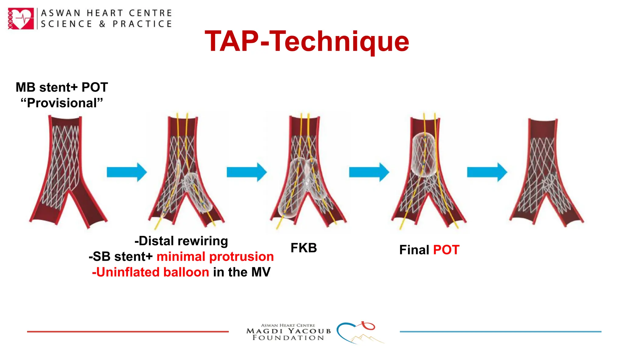 Coronary Bifurcation techniques in a nutshell | PDF