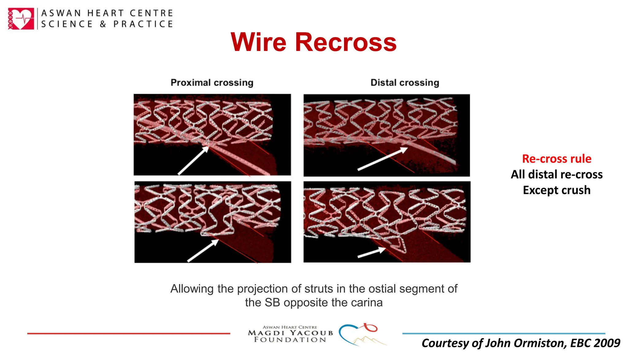 Coronary Bifurcation techniques in a nutshell | PDF