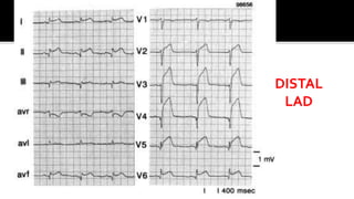 Coronary circulation | PPT
