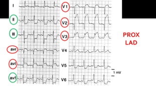 Coronary circulation | PPT