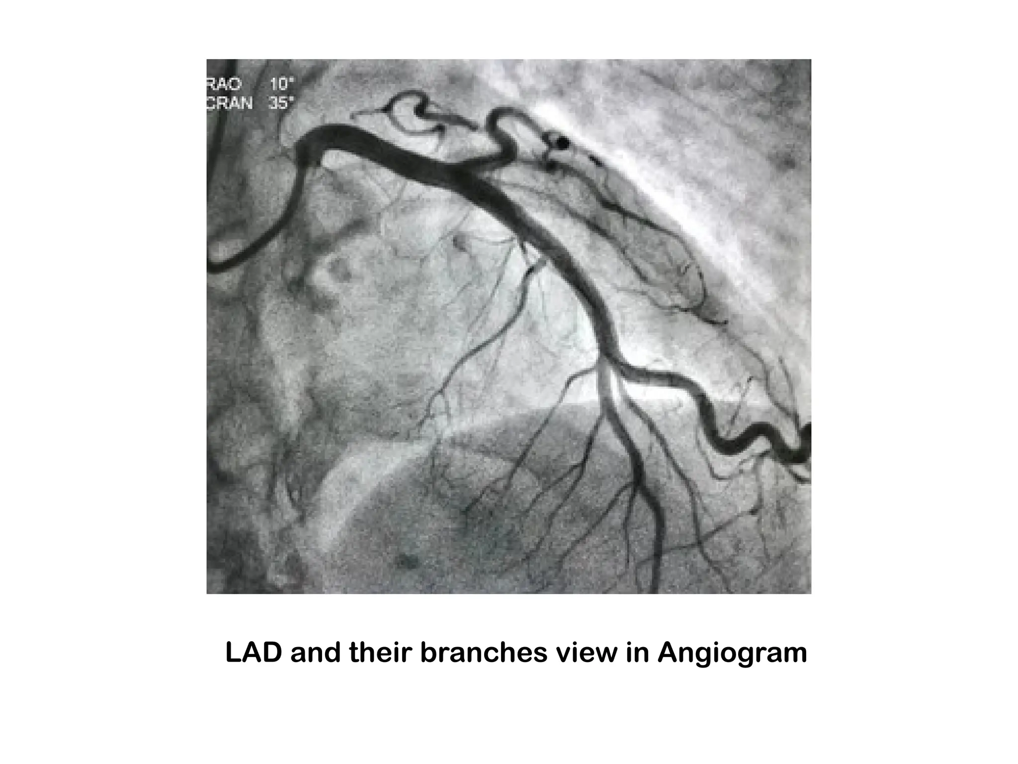 Coronary circulation - LAD, LCX and RCA.pptx