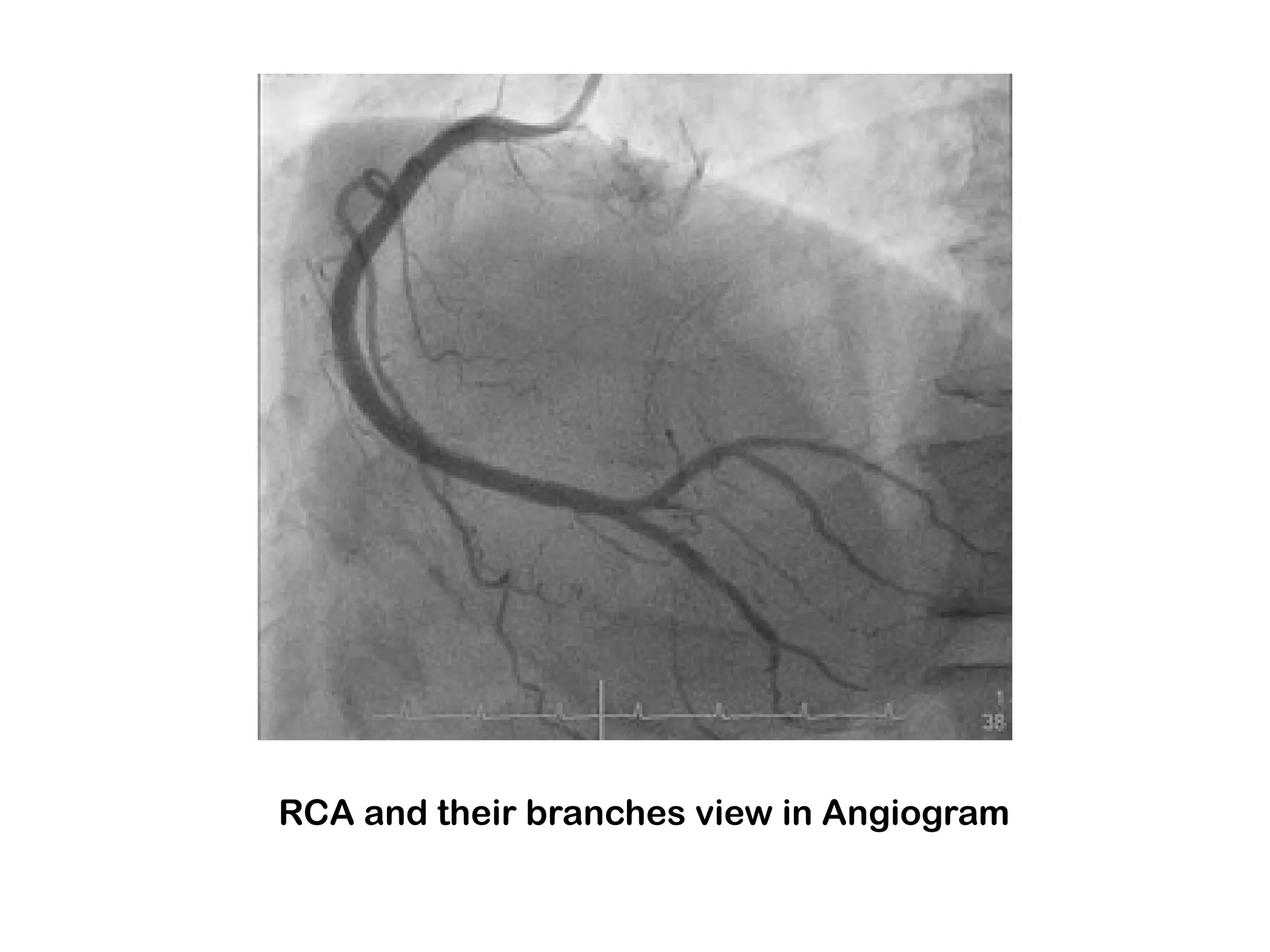 Coronary circulation - LAD, LCX and RCA.pptx