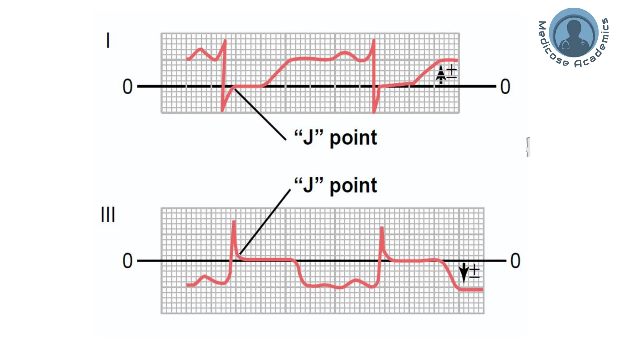 Coronary Circulation and Ischemic Heart Disease_AntiCopy.pdf