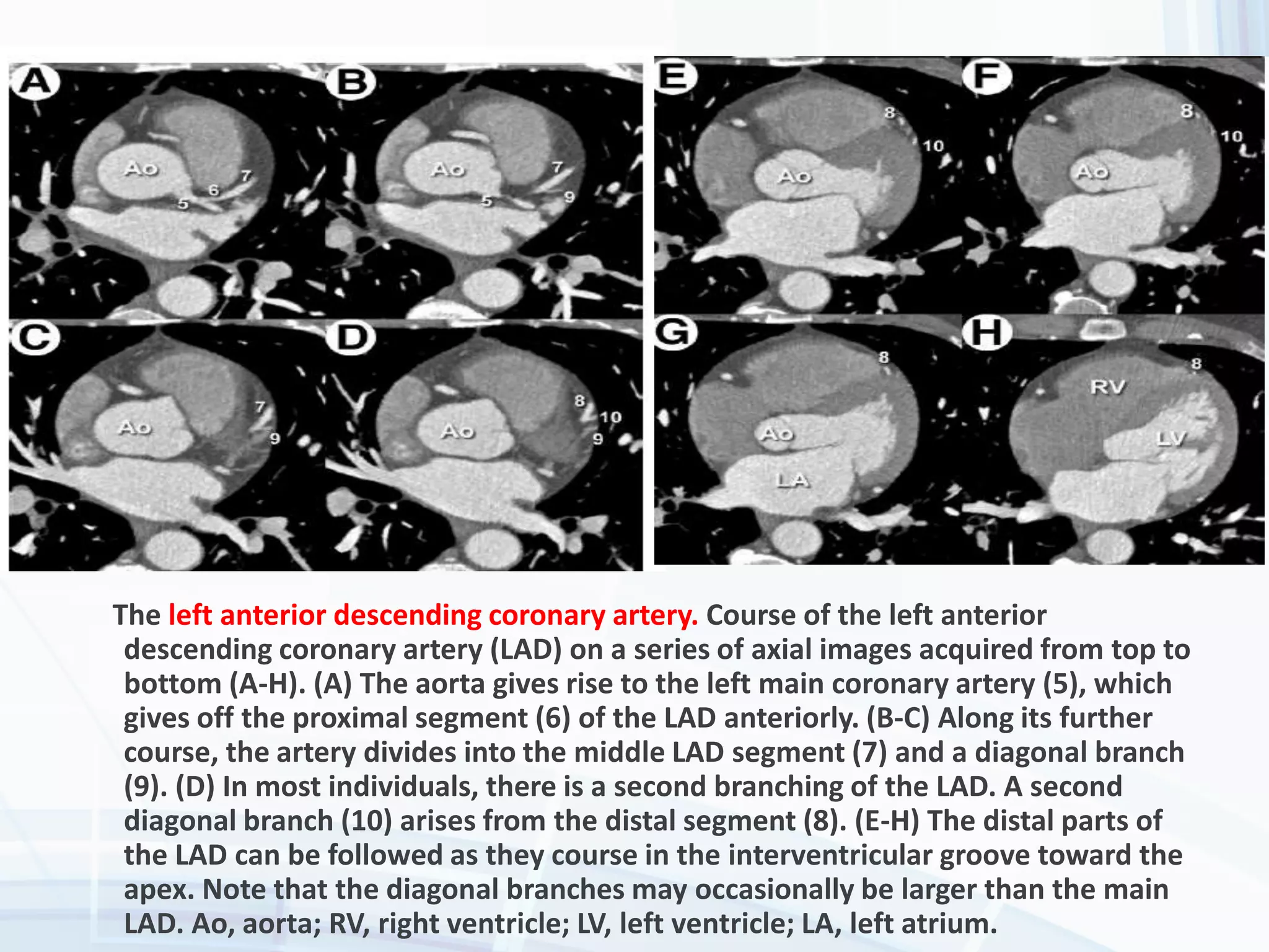 Coronary CT | PPTX