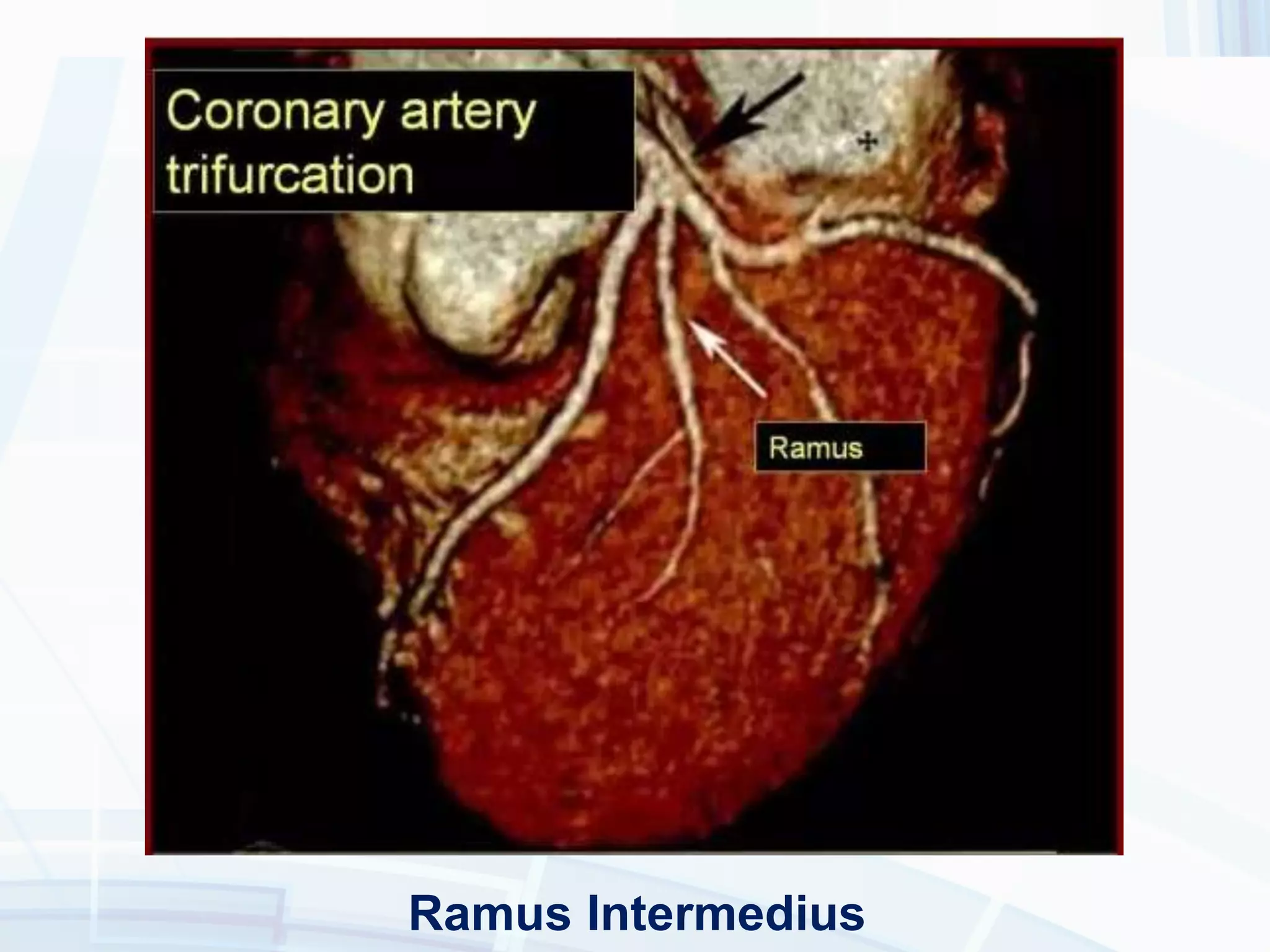 Coronary CT | PPTX