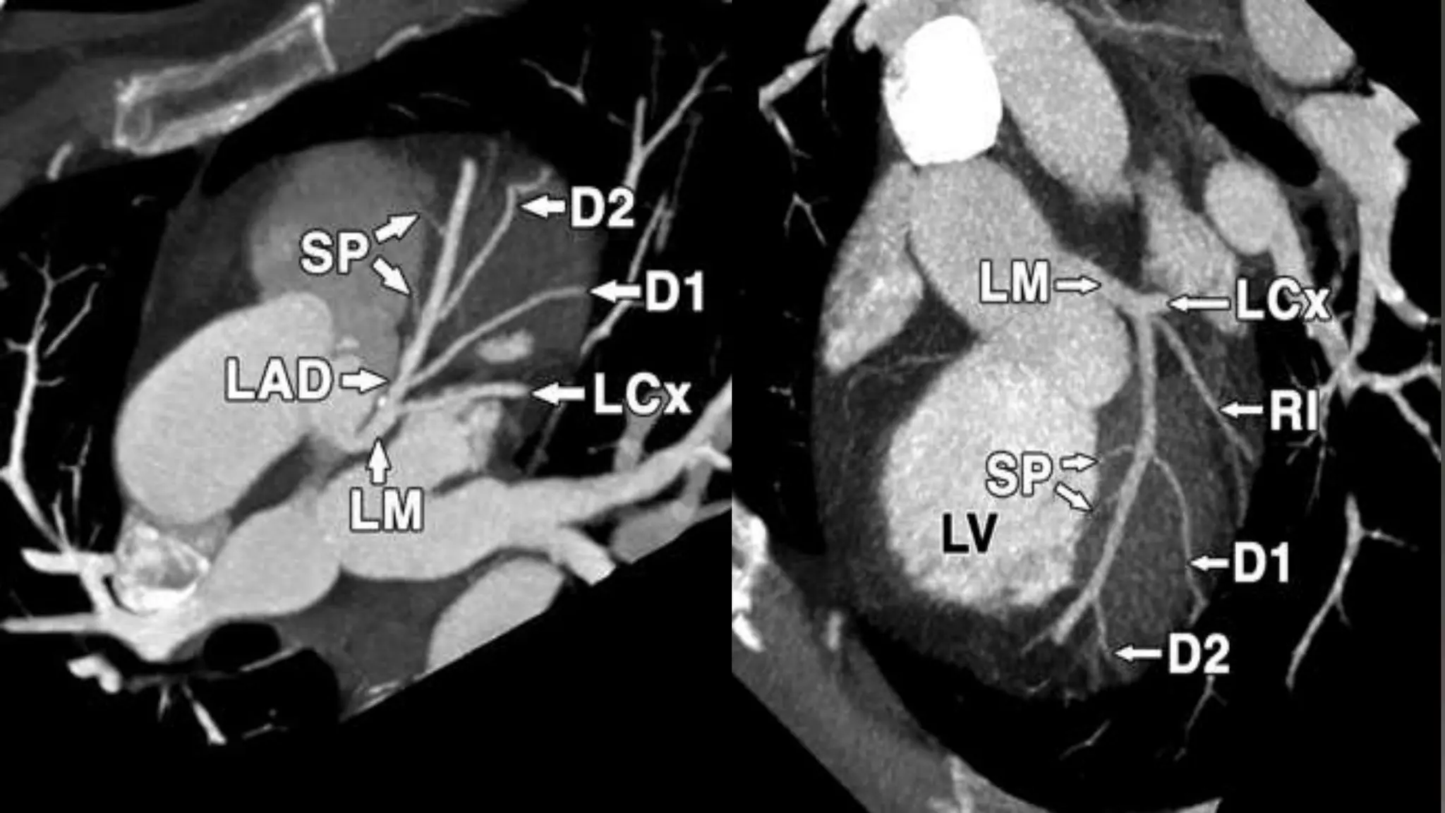 Coronary CTA | PPTX