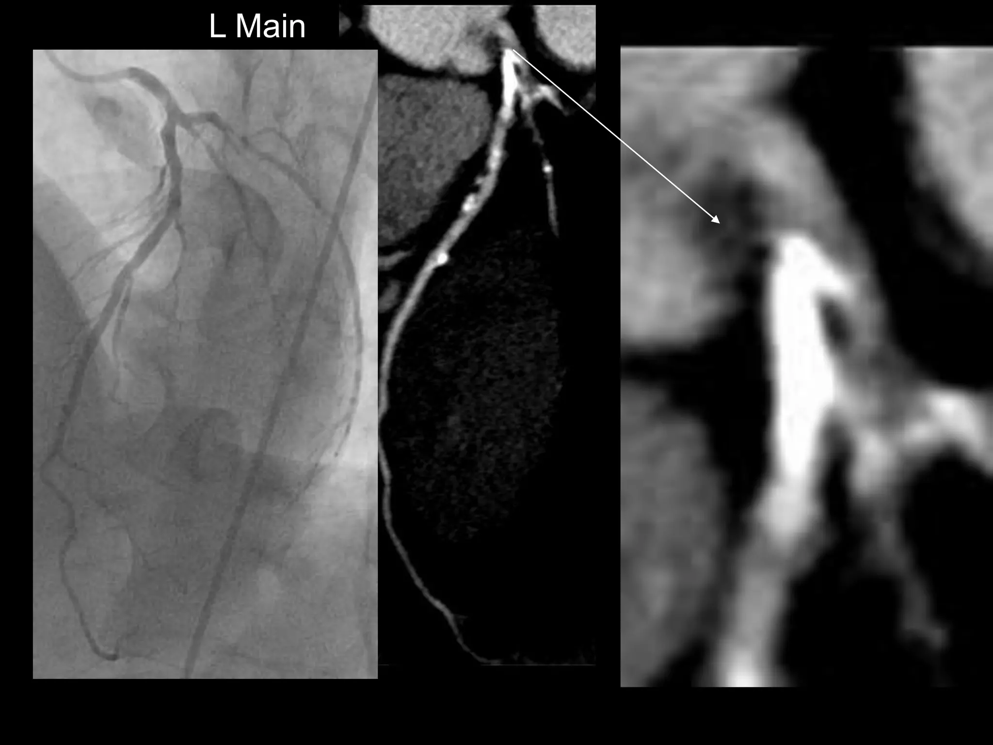 Coronary CTA: The test of choice for obstructive CAD. | PPTX