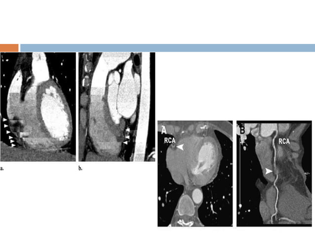 Coronary CT- angiogram: physics | PPT