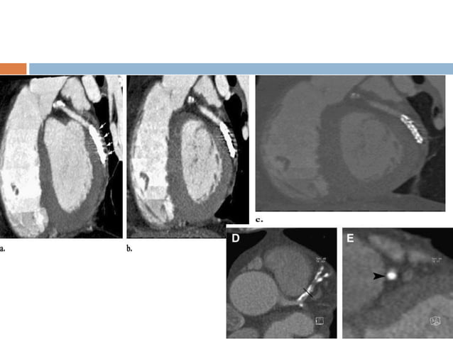 Coronary CT- angiogram: physics | PPT