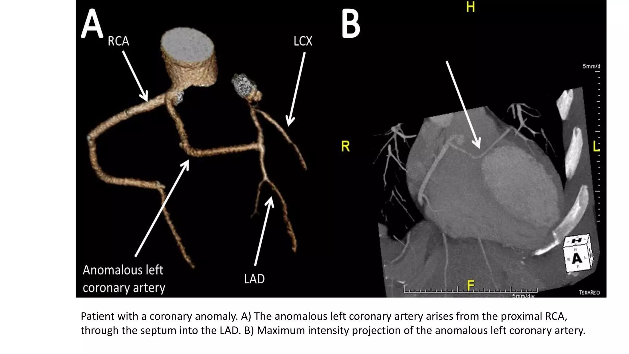 Coronary CT Angiography .dr aya.pdf