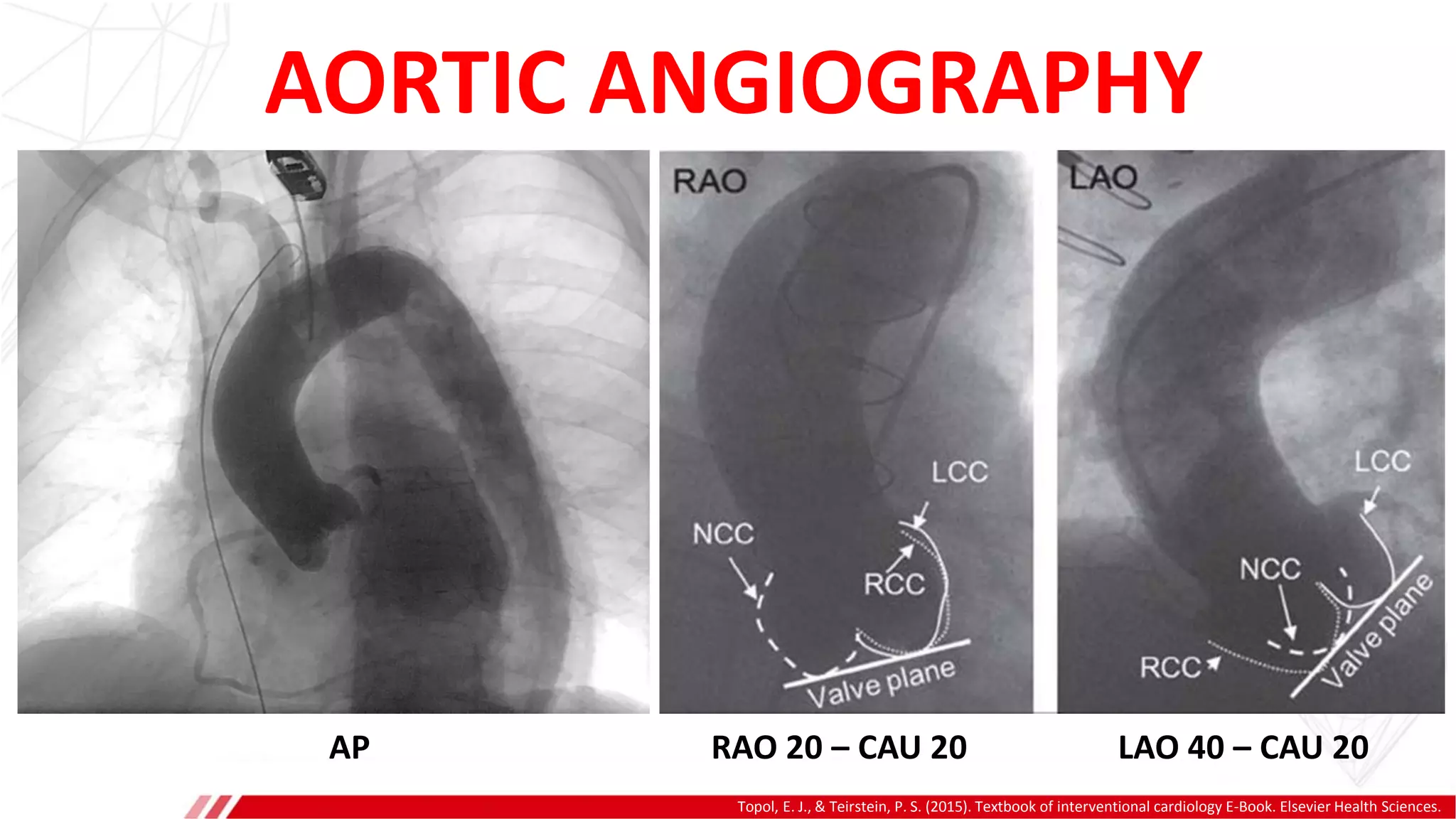 CORONARY ENGAGEMENT.pdf