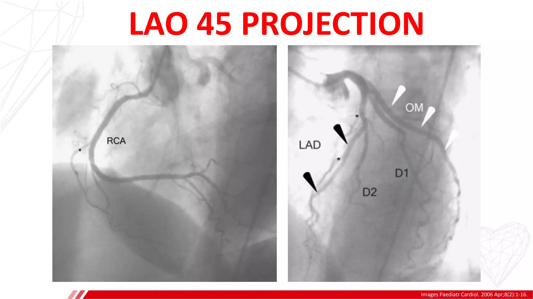 CORONARY ENGAGEMENT.pdf