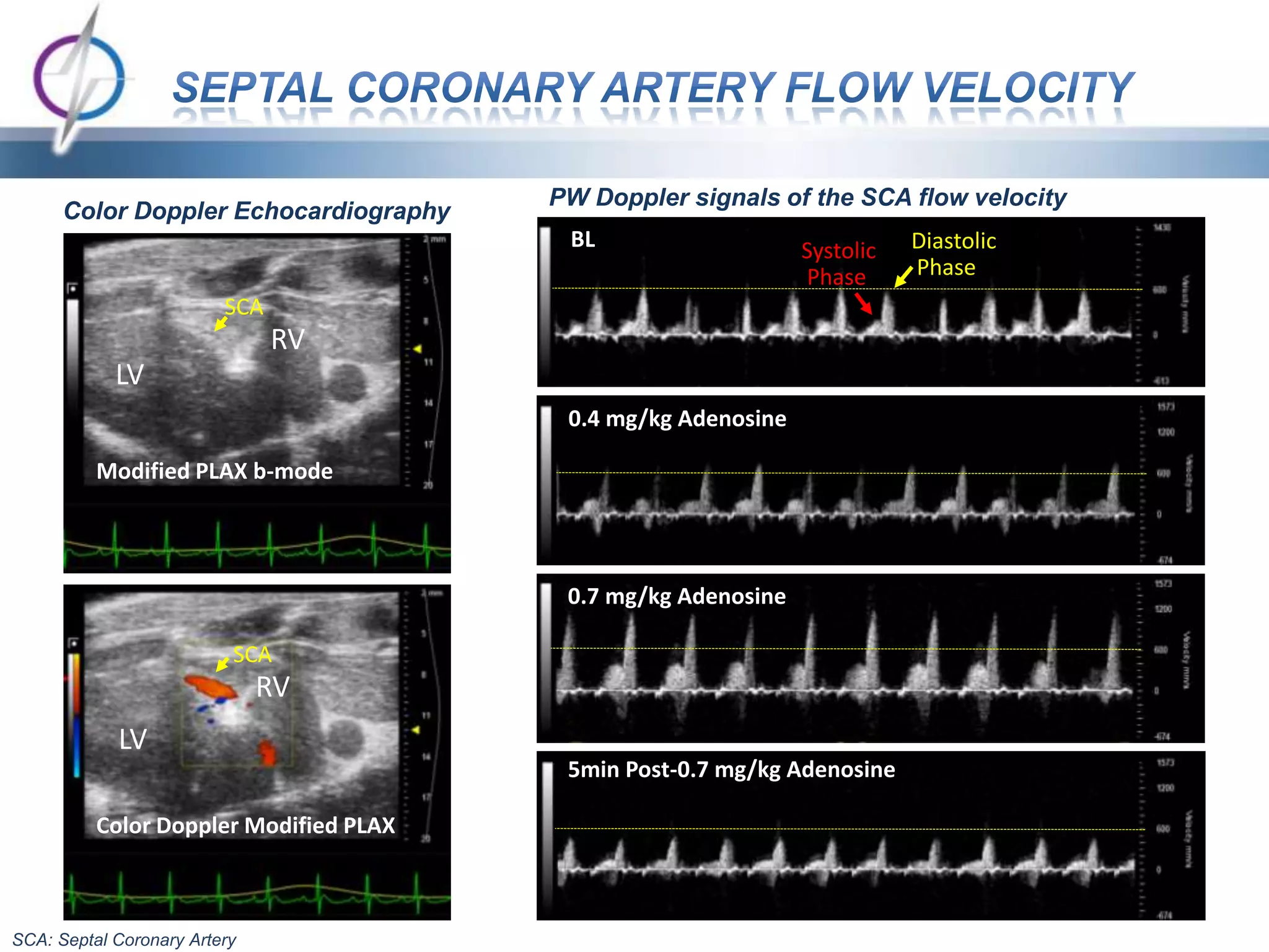 Coronary Flow Via Echocardiography | PPT