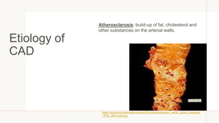 CORONARY HEART DISEASE | PPTX