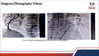 coronary perforation.pptx | Heart and Cardiovascular Diseases ...