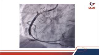 coronary perforation.pptx | Heart and Cardiovascular Diseases ...