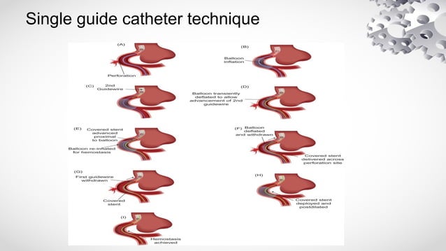 CORONARY PERFORATION - PCI COMPLICATIONS 1.pptx