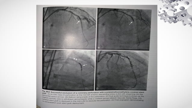 CORONARY PERFORATION - PCI COMPLICATIONS 1.pptx