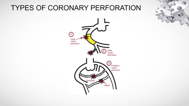 CORONARY PERFORATION - PCI COMPLICATIONS 1.pptx