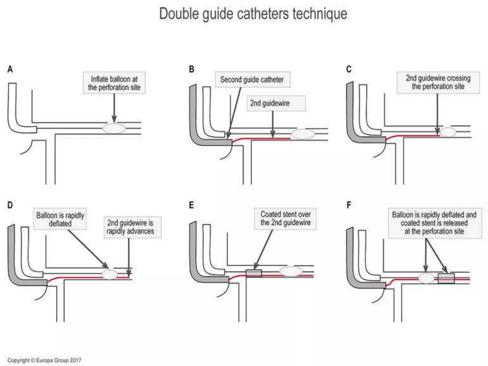 CORONARY PERFORATION ABHISHEK1.pptx | First Aid | Injuries