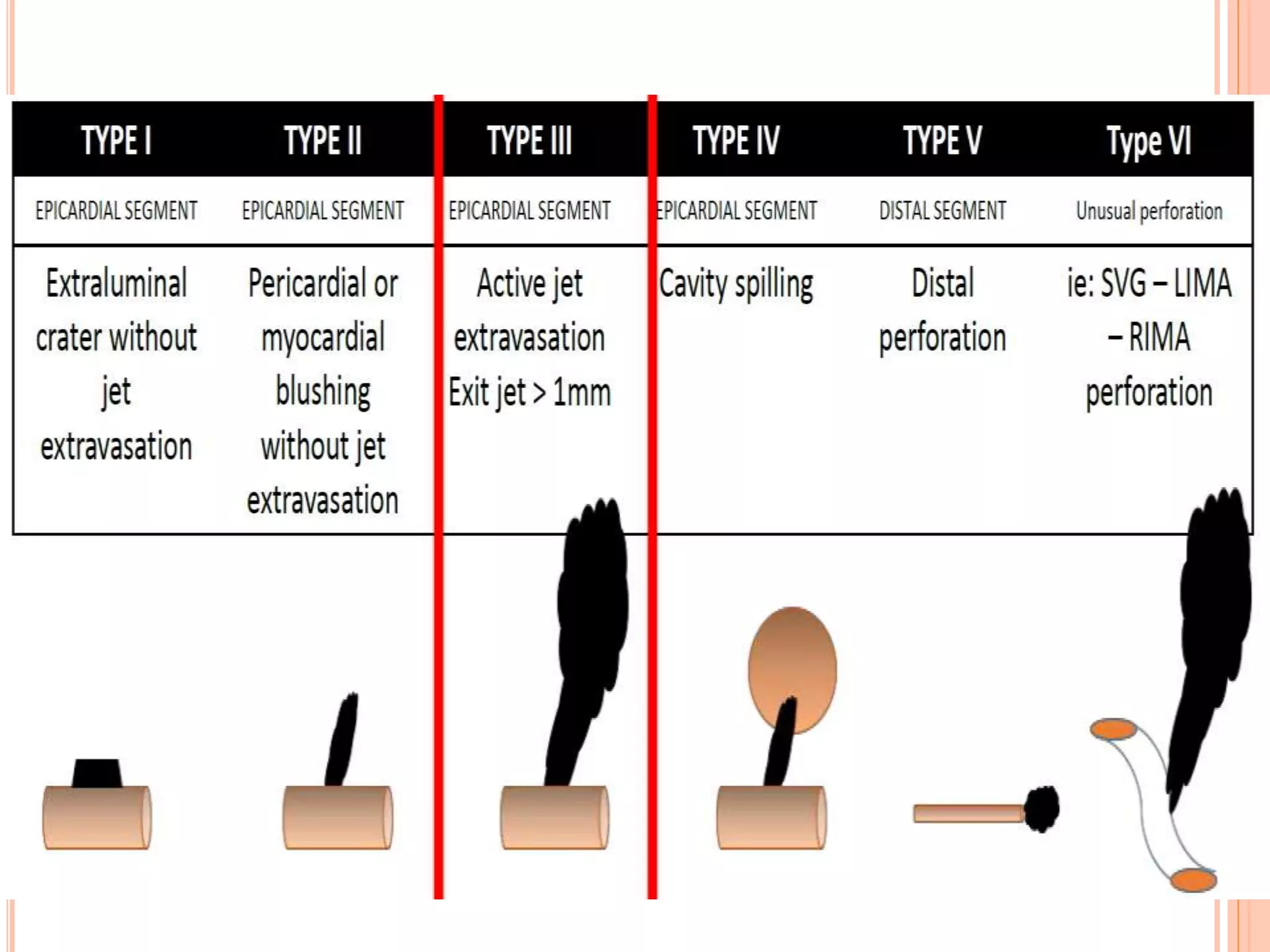 CORONARY PERFORATION ABHISHEK1.pptx | First Aid | Injuries