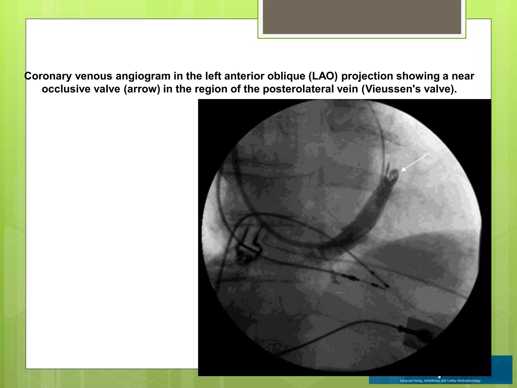 coronary sinus.ppt