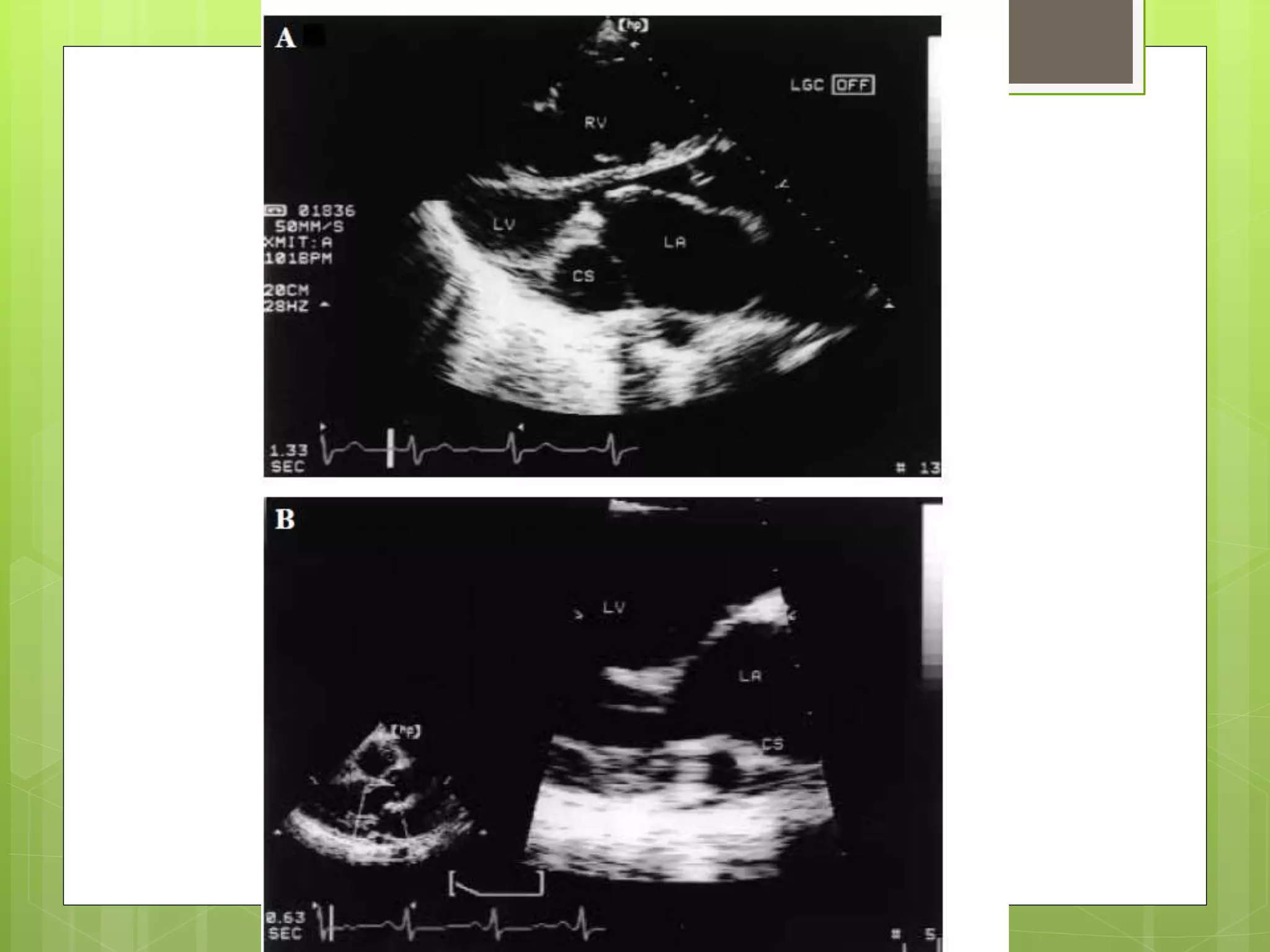 Coronary sinus anatomy | PPTX