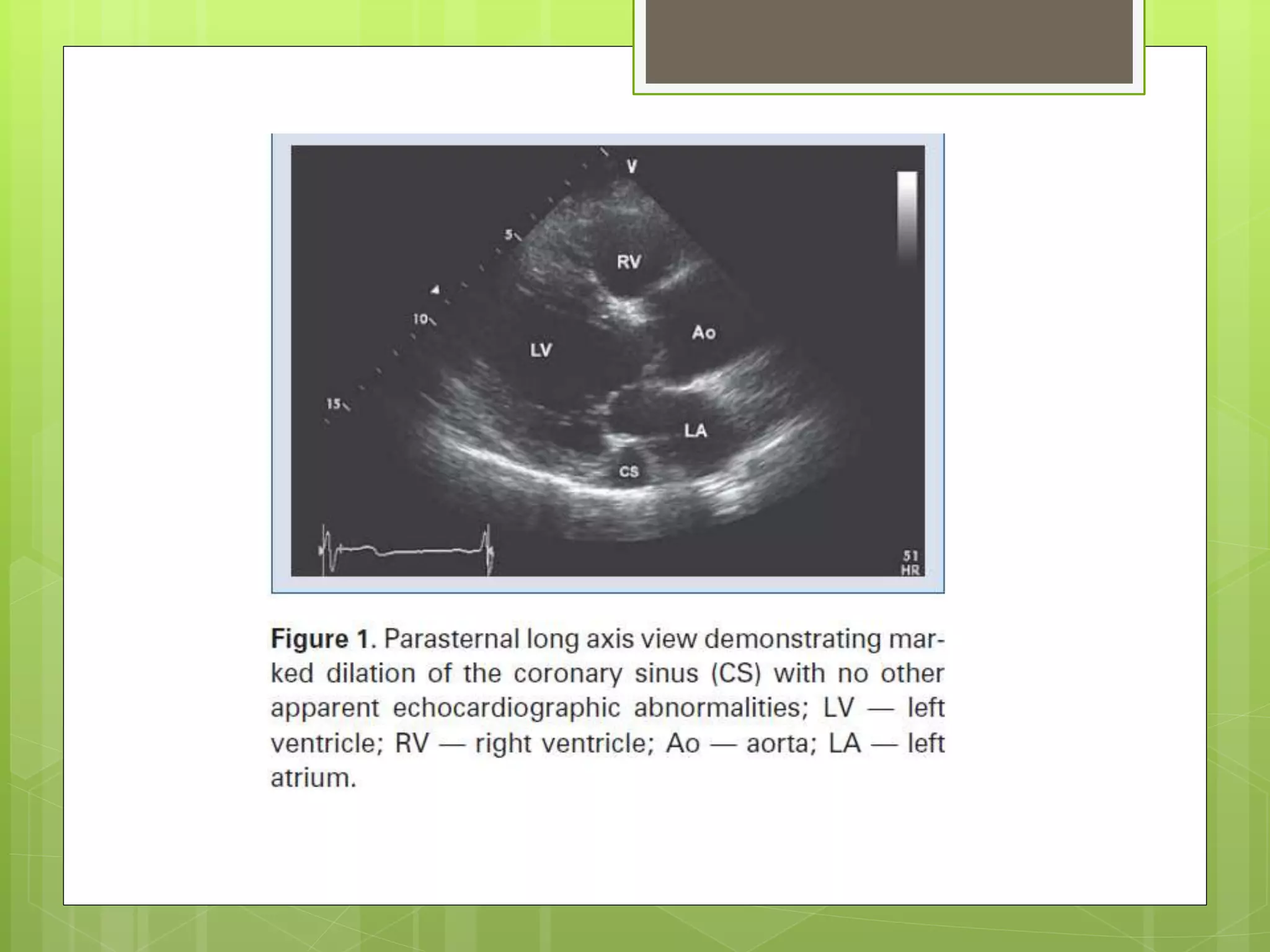 Coronary sinus anatomy | PPTX
