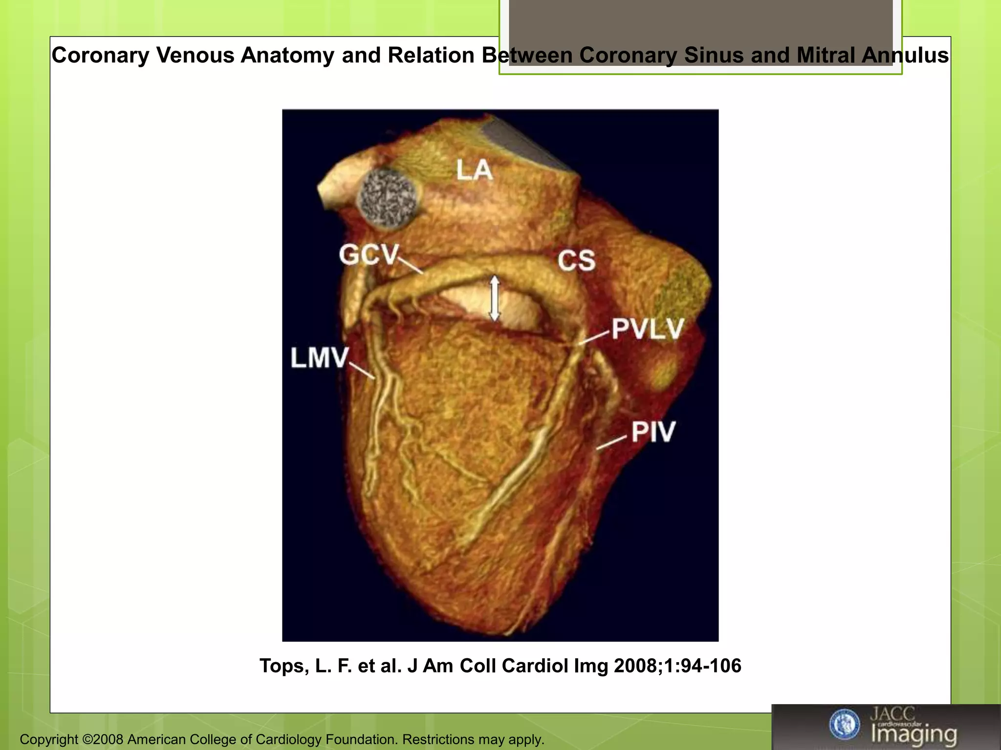 Coronary sinus anatomy | PPTX