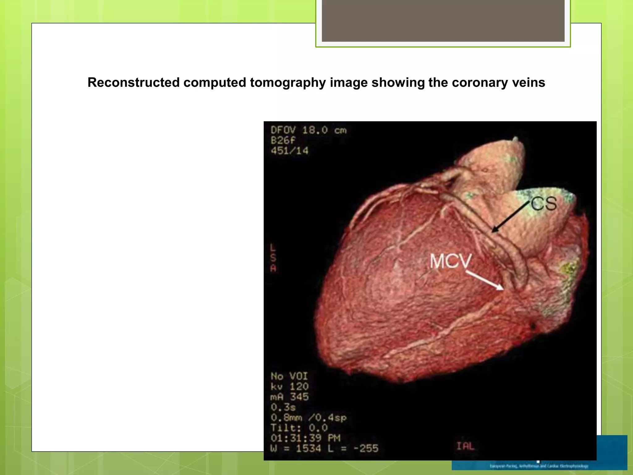 Coronary sinus anatomy | PPTX