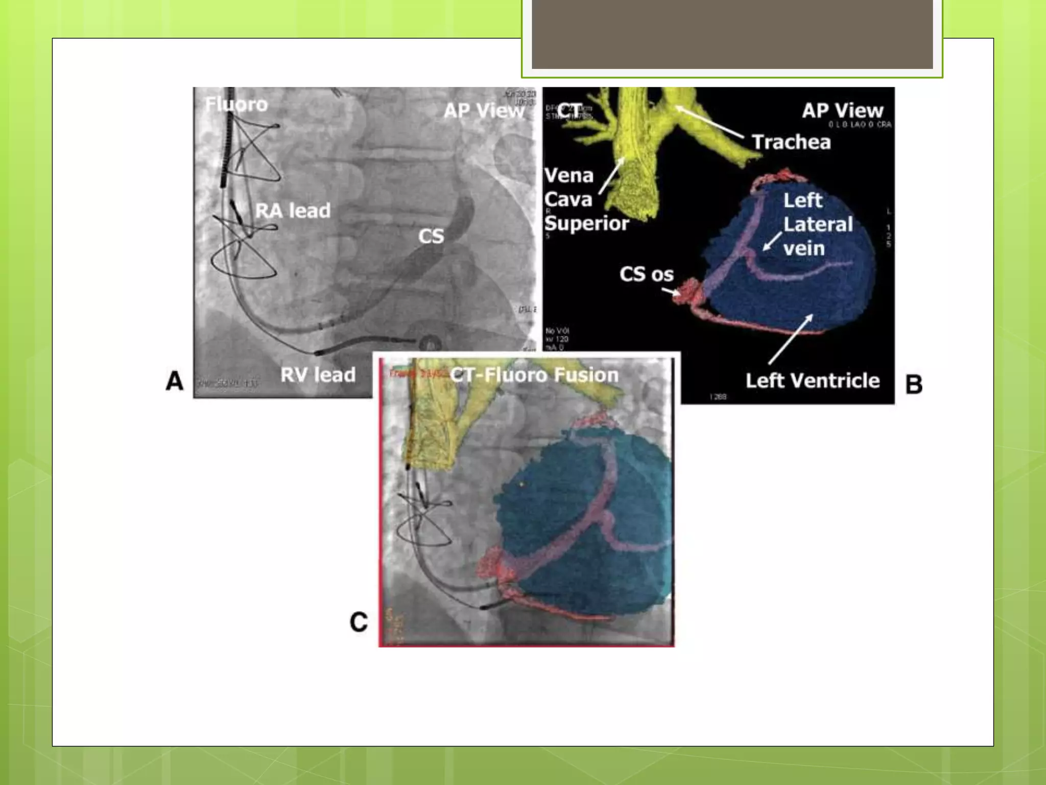 Coronary sinus anatomy | PPTX