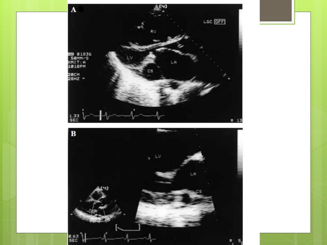 Coronary sinus anatomy | PPTX
