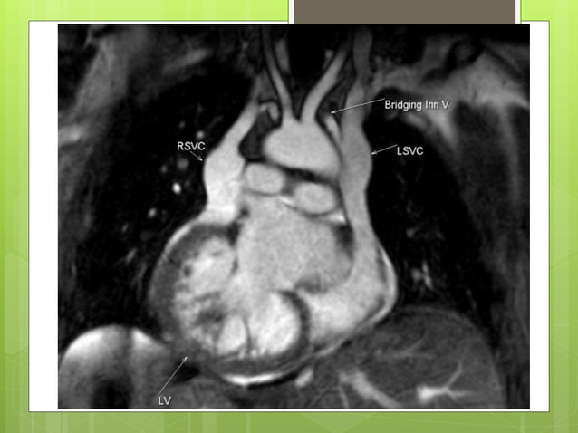 Coronary sinus anatomy | PPTX