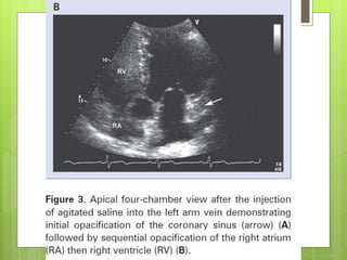 Coronary sinus anatomy | PPTX