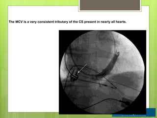 Coronary sinus anatomy | PPTX